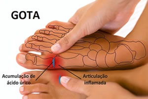 Gota (A Doença dos Reis): Por que a Dor é Tão Intensa e Como Tratar em ...